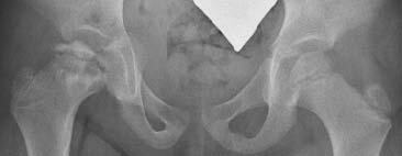 Perthes Disease | International Center for Limb Lengthening